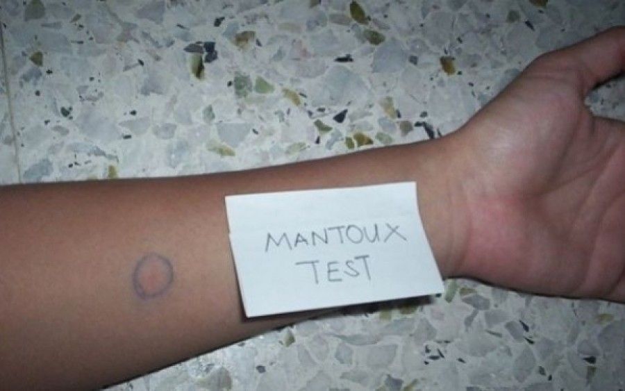 Tεστ Mantoux (μαντού): Τι είναι και γιατί πρέπει να γίνεται