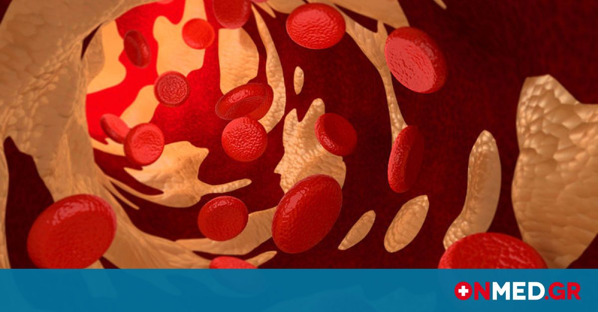 Χοληστερόλη LDL, HDL, VLDL, ολική: Ποιες είναι οι φυσιολογικές τιμές