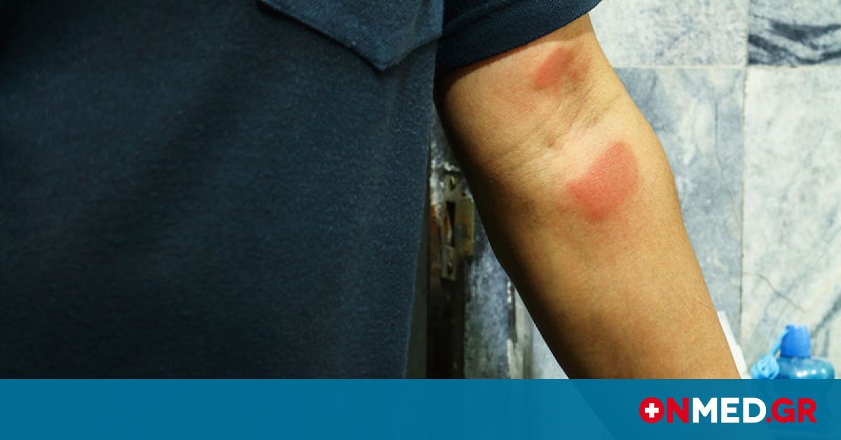 Ατοπική Δερματίτιδα: Η πρώτη στοχευμένη βιολογική θεραπεία για ενήλικες ...