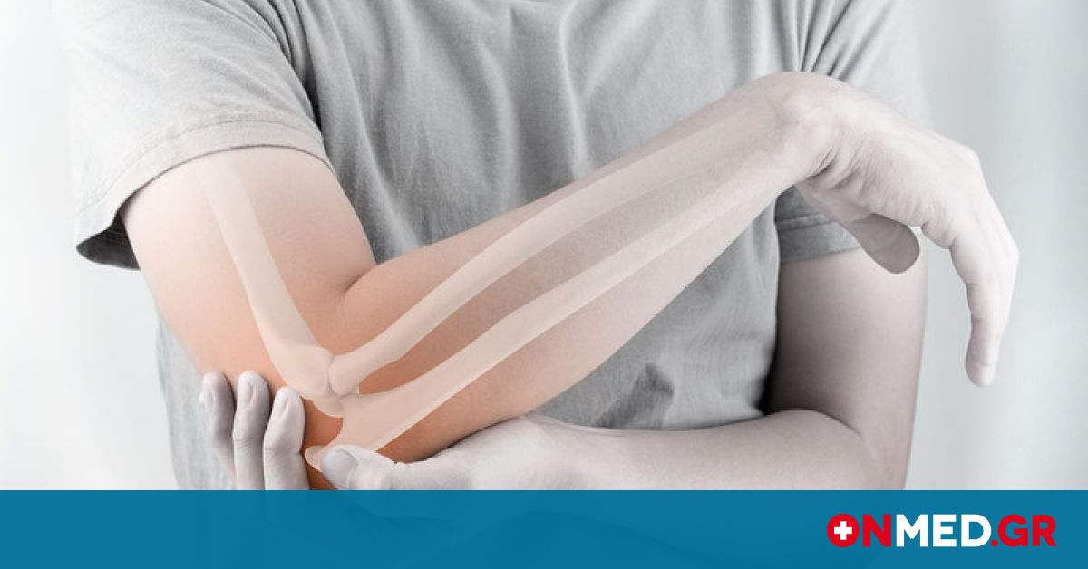 Η οστεοαρθρίτιδα μπορεί να προληφθεί – Ποια 2 μέτρα πρέπει να υιοθετήσετε