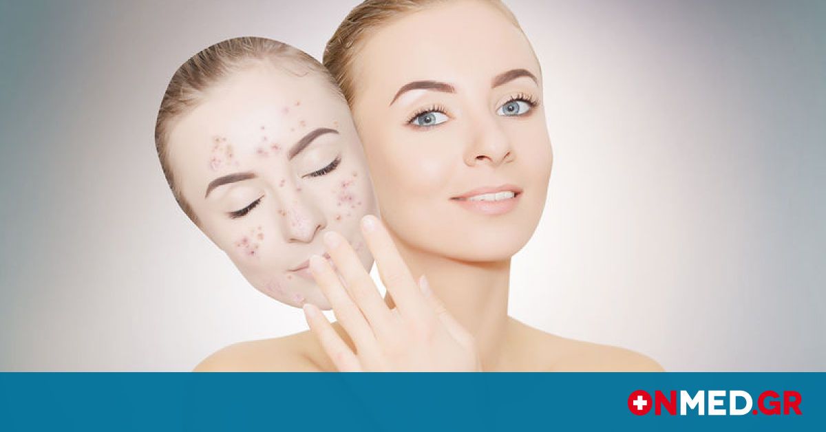 Σπυράκια: Ποιες παθήσεις τα προκαλούν & πώς αντιμετωπίζονται