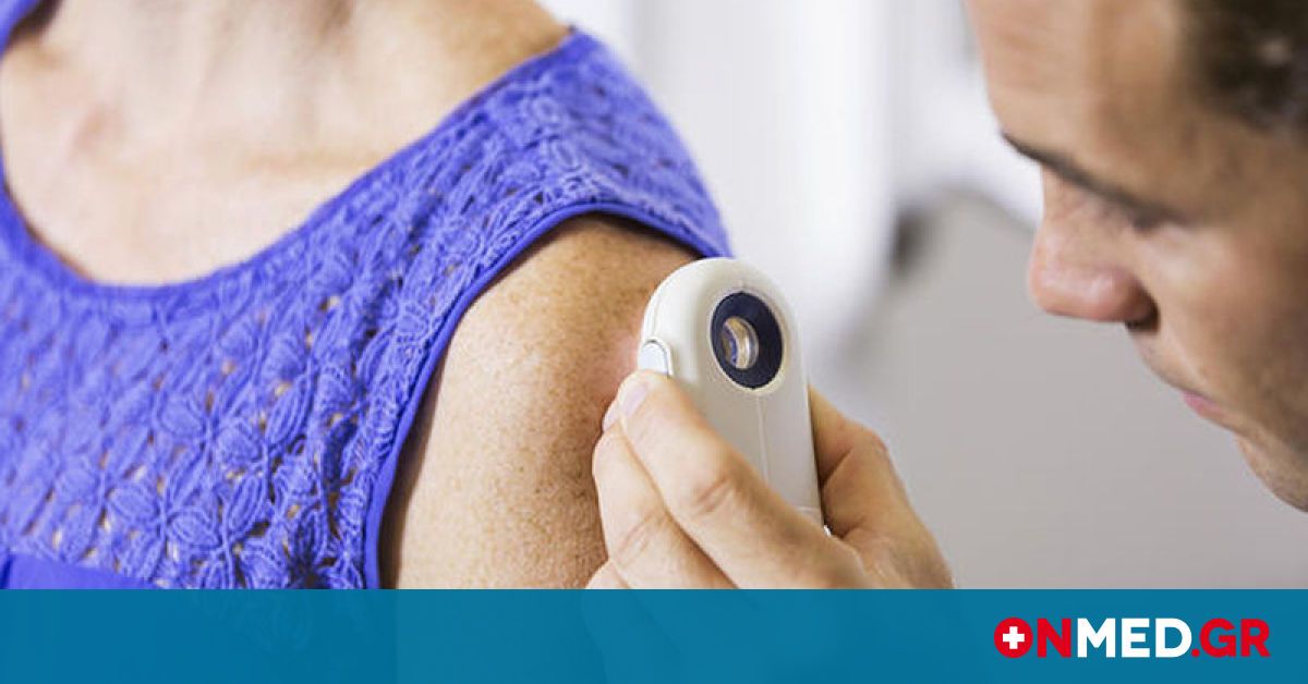 Καρκίνος του δέρματος: 4 άγνωστοι τρόποι προστασίας