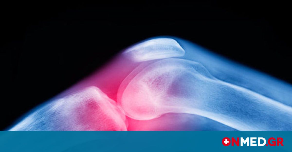 Οστεοαρθρίτιδα γόνατος: Οι 3 ασκήσεις που αυξάνουν τον κίνδυνο