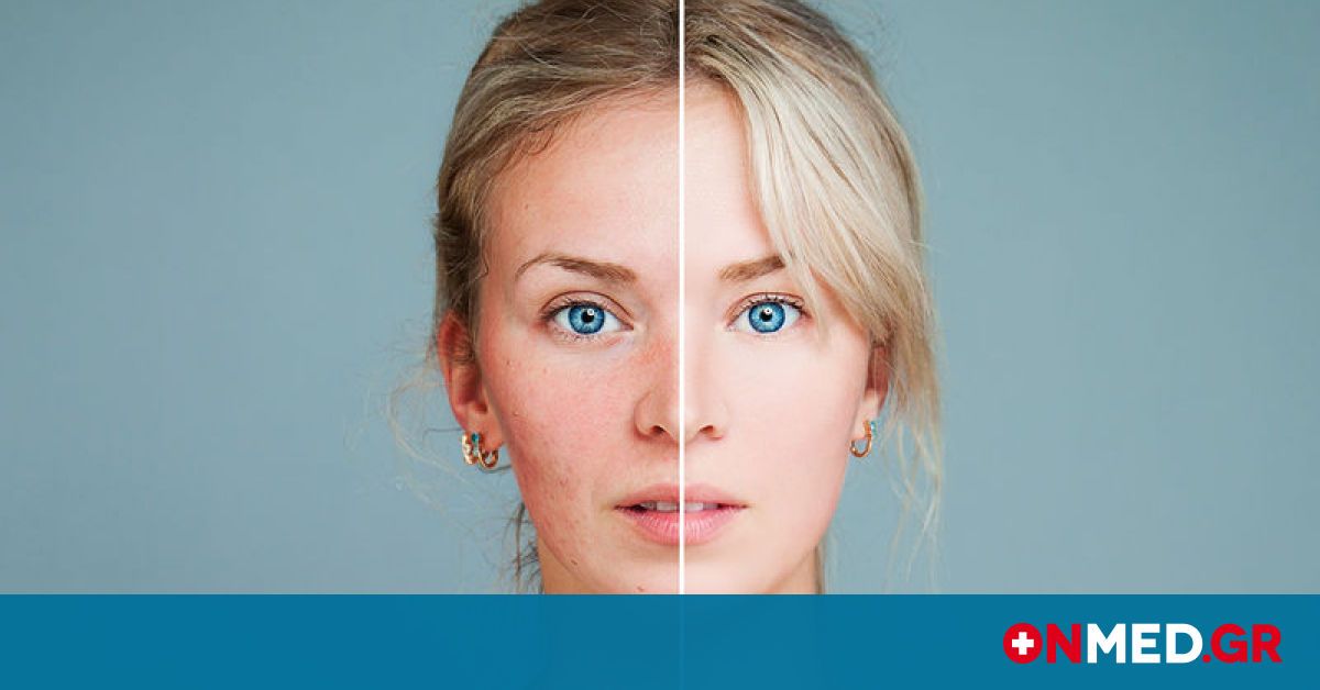 Τέσσερις αλλαγές στο πρόσωπο που δείχνουν πρόβλημα υγείας