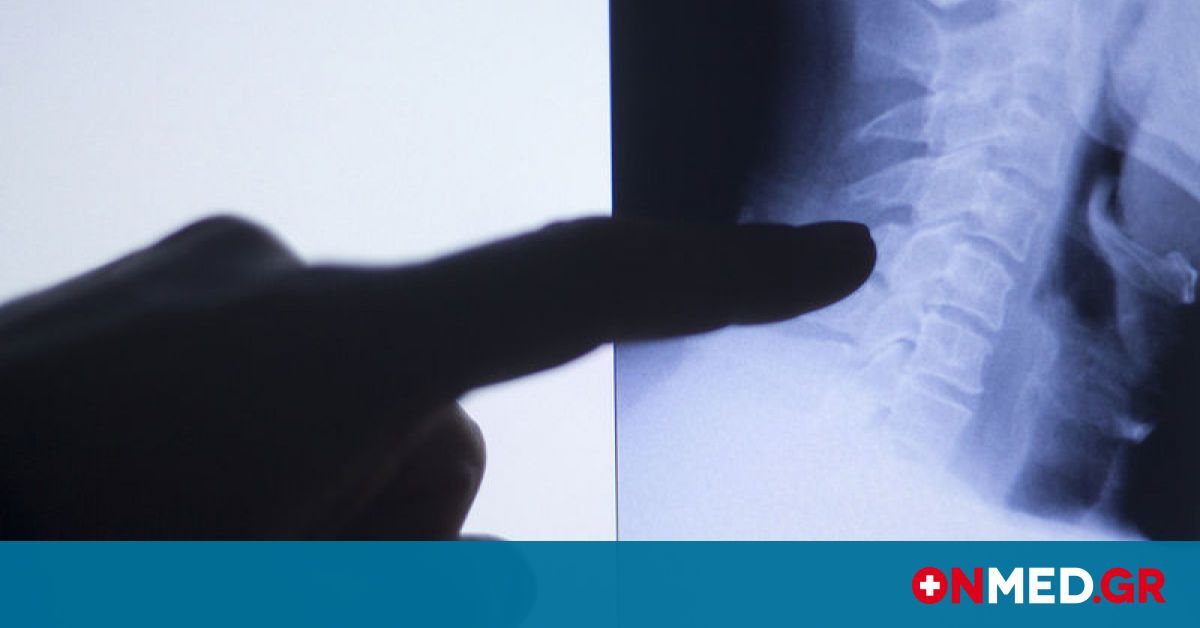 Αγκυλοποιητική σπονδυλοαρθρίτιδα: Κλινική μελέτη ξεκινά η Novartis ...