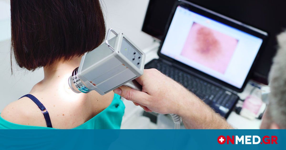 Μελάνωμα: Ακριβείς και αξιόπιστες διαγνώσεις χάρη σε σύστημα τεχνητής ...
