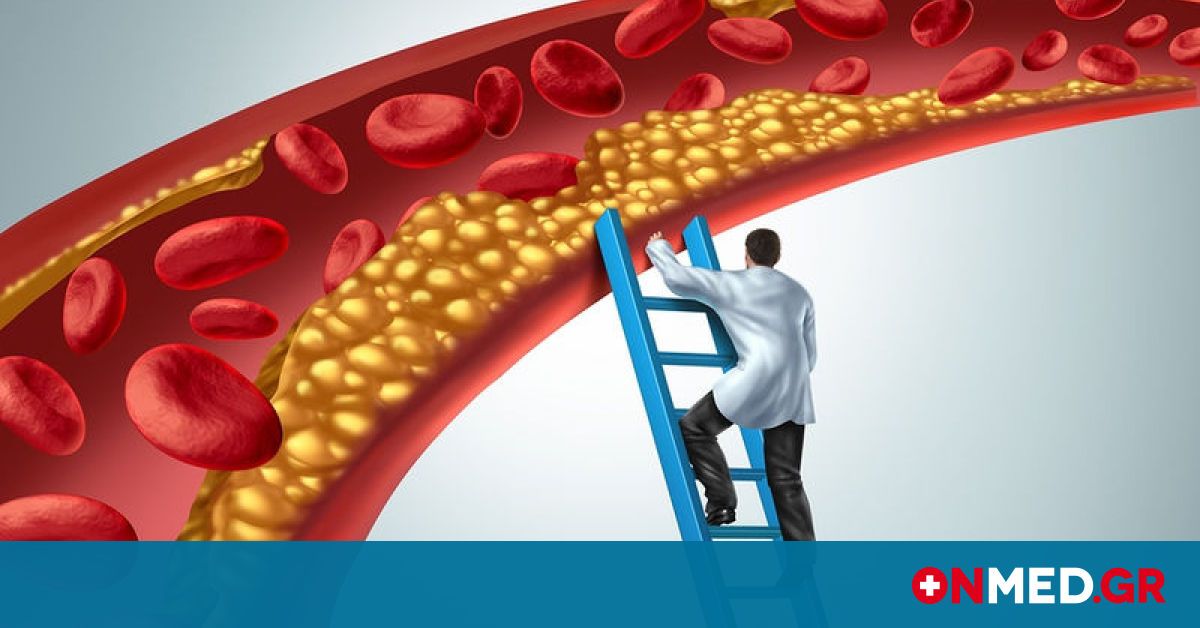 Στένωση αρτηριών: Τι να τρώτε και τι να αποφεύγετε (εικόνες)