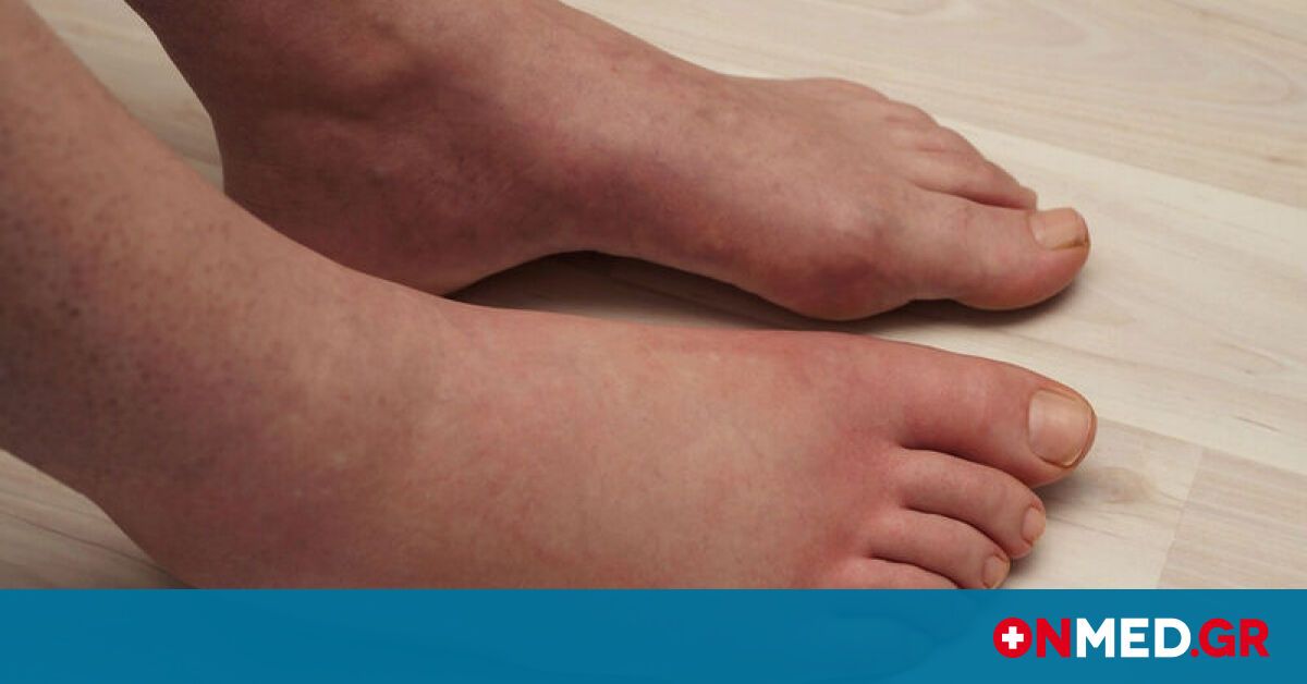 Πρησμένα πόδια: 5 πιθανές αιτίες που πρέπει να γνωρίζετε (pics)