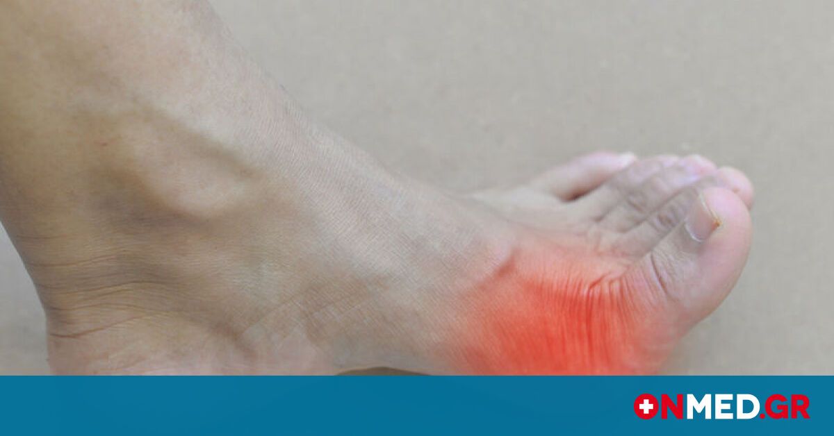 Ανεβασμένο ουρικό οξύ: Δείτε πώς θα το μειώσετε (εικόνες)