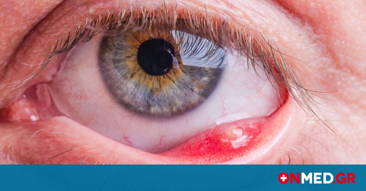 Κριθαράκι στο μάτι: 9 εύκολοι τρόποι για να υποχωρήσει (εικόνες)