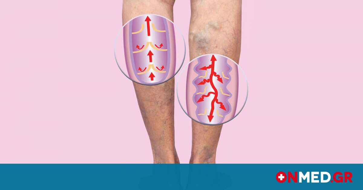 Αντιμετωπίστε τη φλεβίτιδα με 10 φυσικούς τρόπους (video)