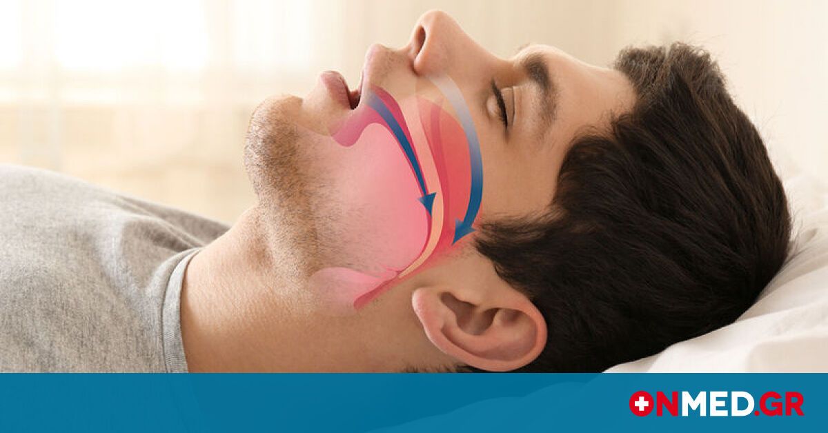 Υπνική άπνοια: Τι την προκαλεί; (video)