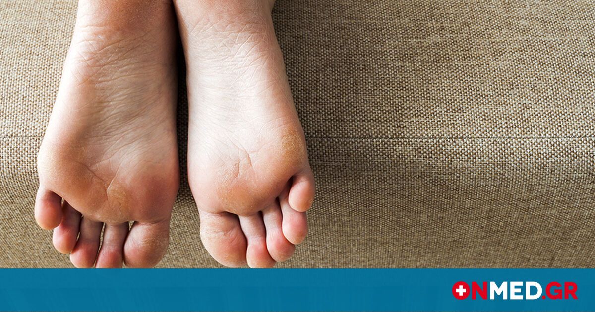 4 δερματικές παθήσεις των ποδιών και τα συμπτώματά τους (εικόνες)
