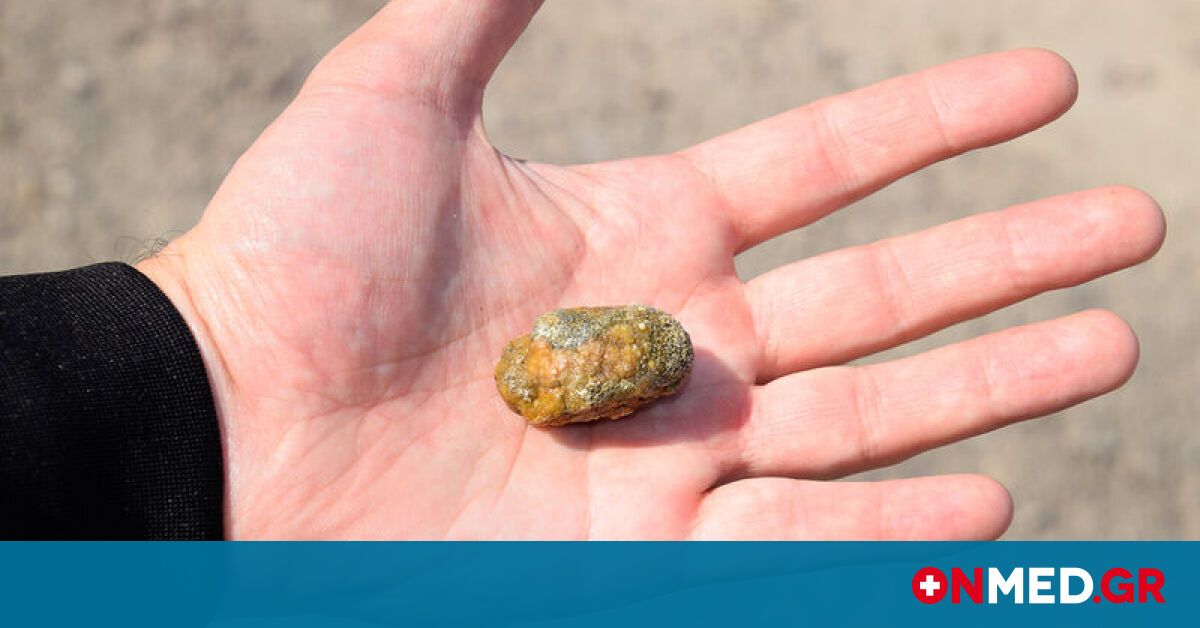 Πέτρες στη χολή: 5 σημάδια που στέλνει το σώμα (εικόνες)