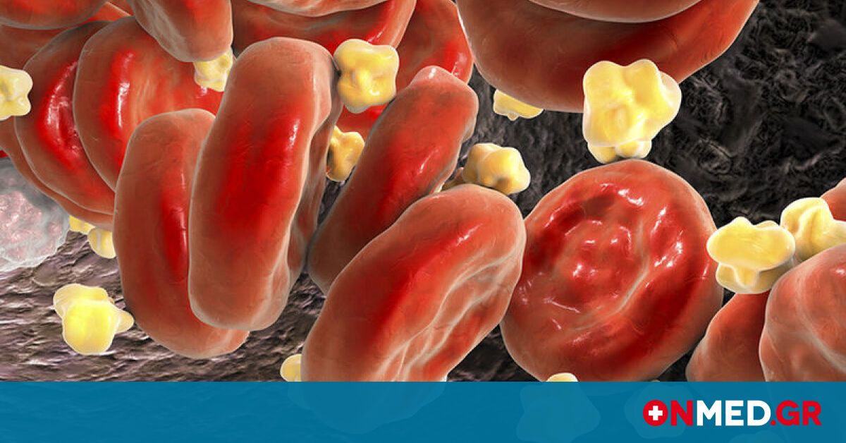 Πέντε πανεύκολα βήματα για τη μείωση της χοληστερίνης (εικόνες)