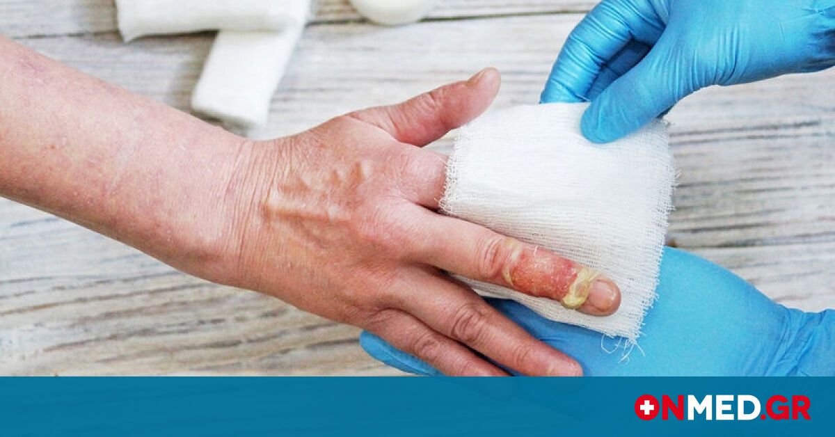 Έγκαυμα πρώτου βαθμού: 6 βήματα αντιμετώπισης στο σπίτι (video)