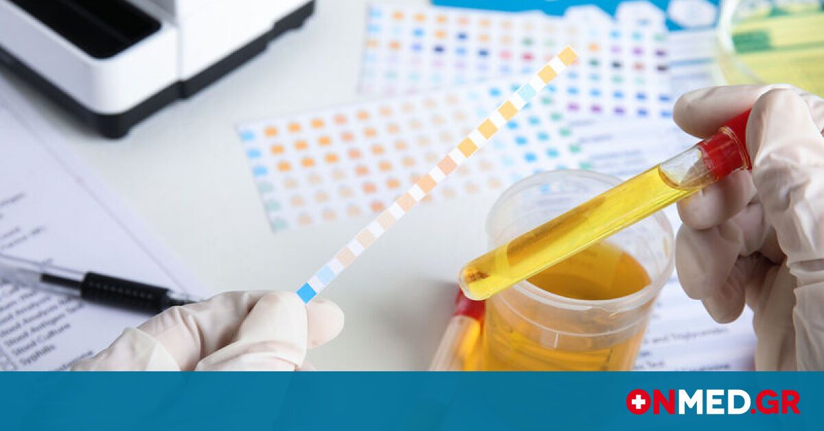 Παθήσεις που επηρεάζουν το χρώμα των ούρων (εικόνες)