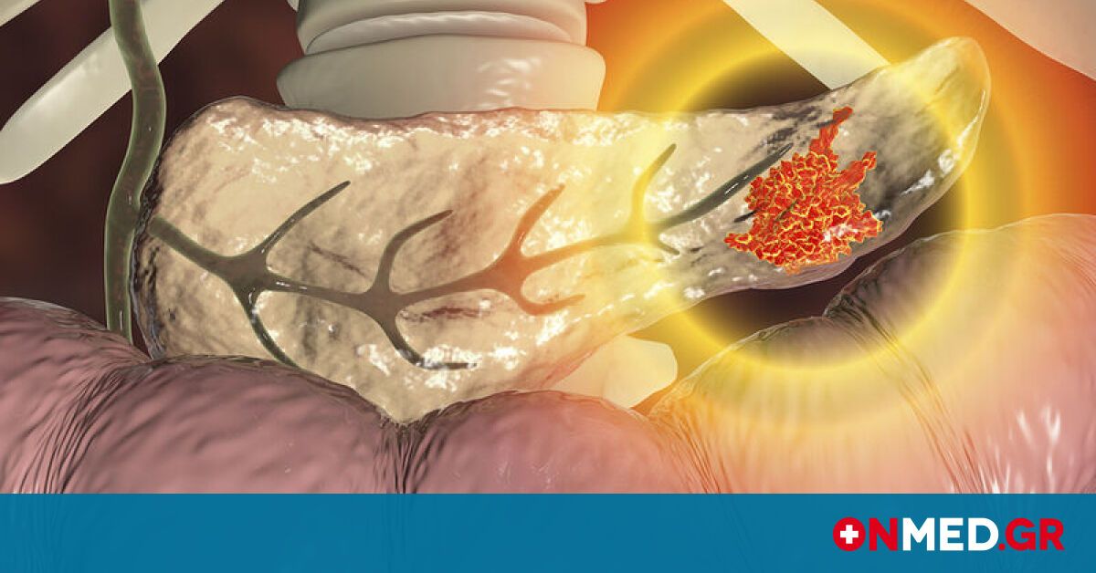 Πάγκρεας: Τα ανησυχητικά σημάδια που πρέπει να γνωρίζετε (εικόνες)