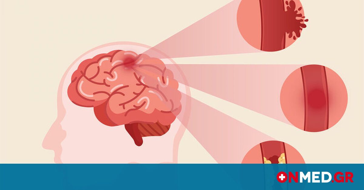 Εγκεφαλικό: 15 παράγοντες που αυξάνουν τον κίνδυνο (βίντεο)
