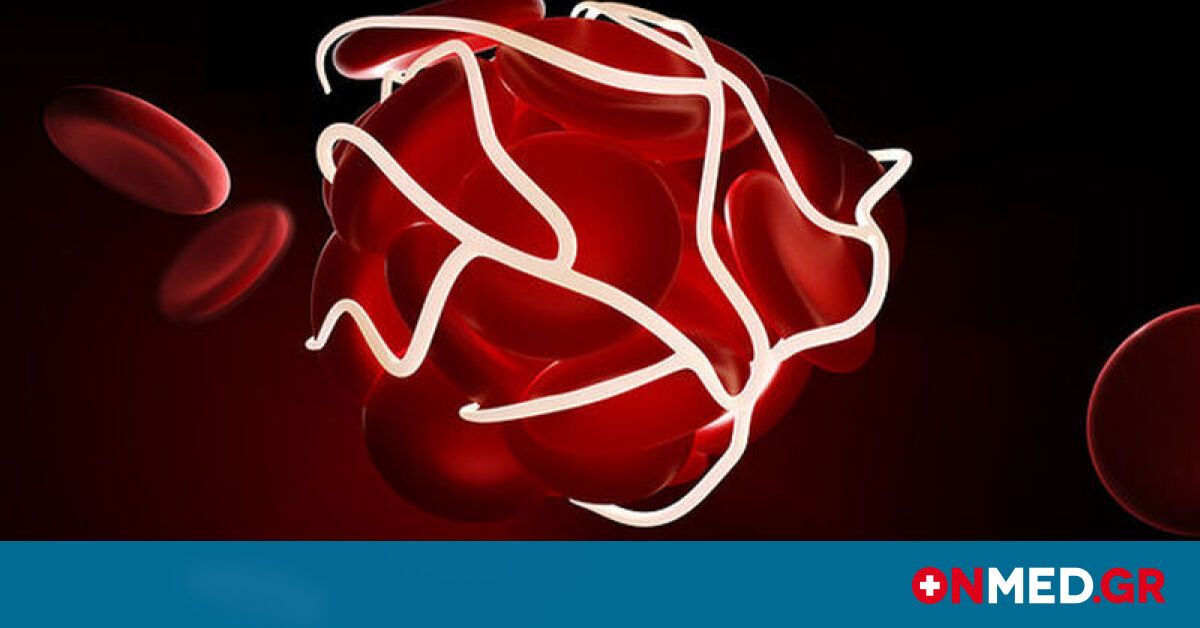 Θρόμβωση: Οι 4 βασικοί κανόνες πρόληψης (εικόνες)