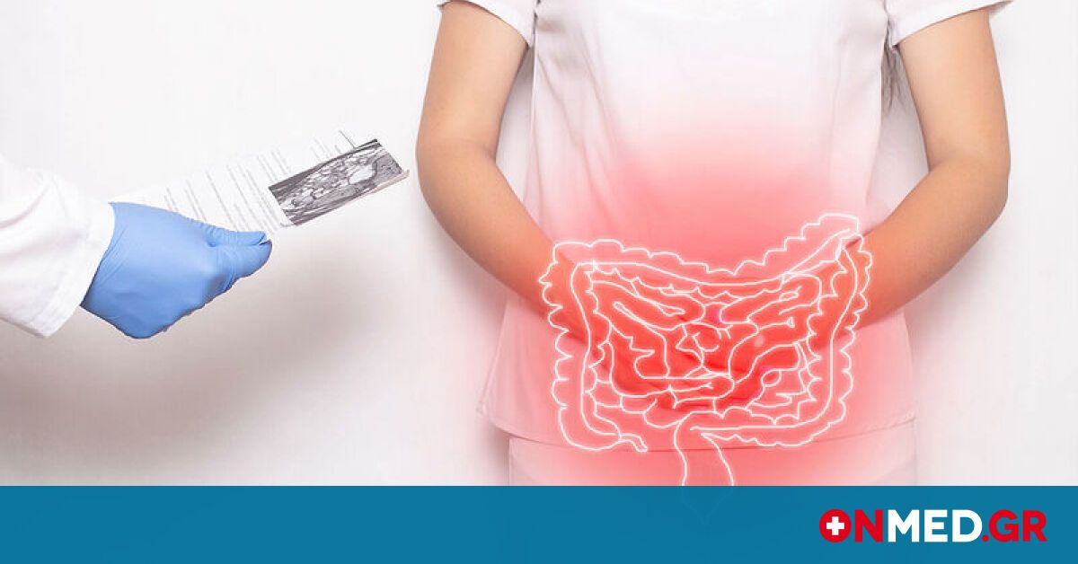 Φλεγμονή εντέρου: Με ποια συμπτώματα εκδηλώνεται (εικόνες)