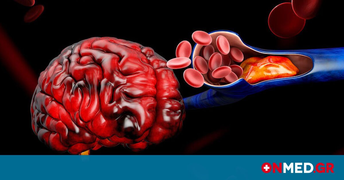 Θρόμβωση: Ποιοι άνθρωποι αντιμετωπίζουν πολλαπλάσιο κίνδυνο