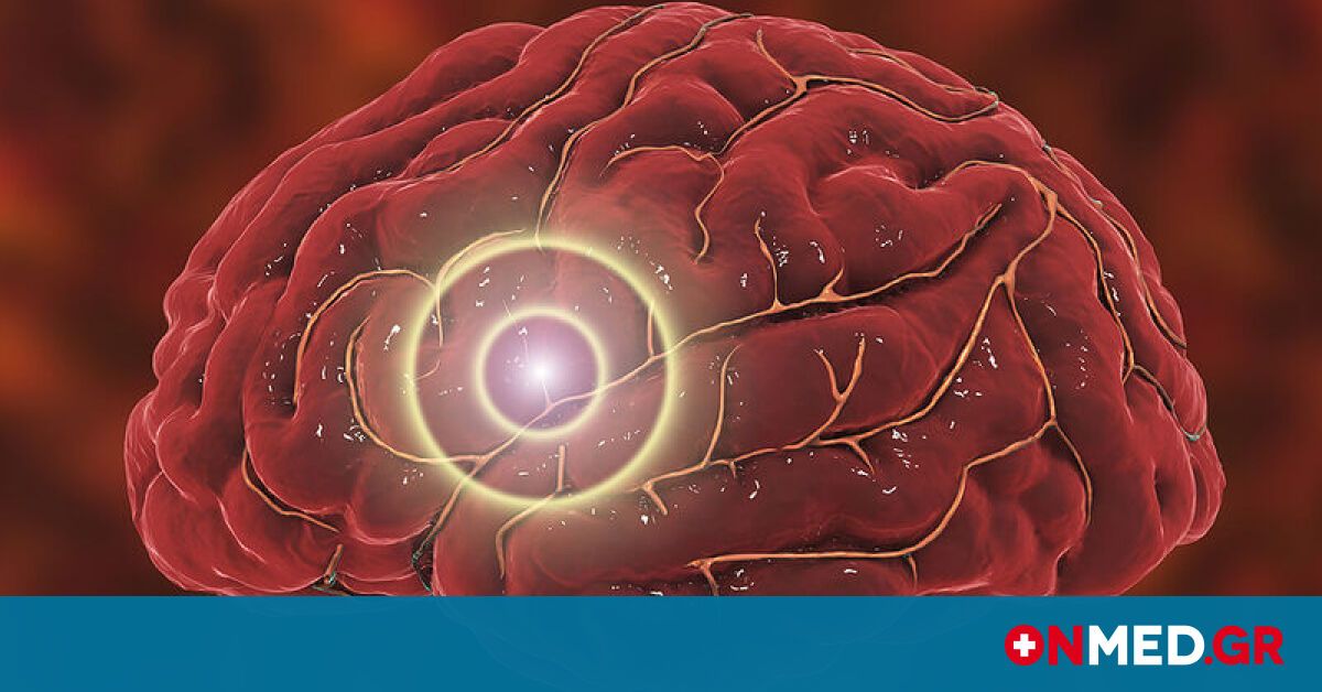 Έμφραγμα / εγκεφαλικό: Πώς θα μειώσετε τον κίνδυνο νέου καρδιαγγειακού ...