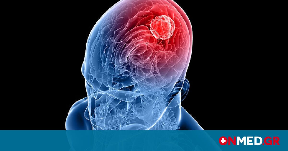 Καινοτόμα θεραπεία εγκεφαλικών όγκων με RNA από επιστήμονες στις ΗΠΑ με ...