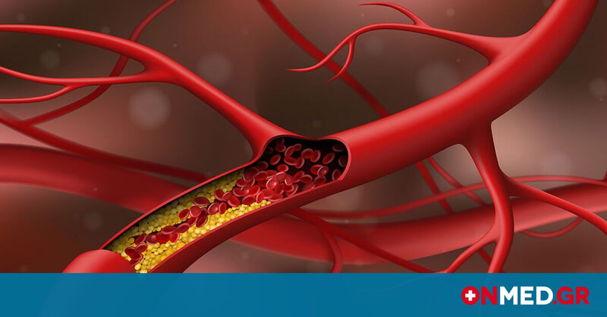 Χοληστερίνη: 13 φυσικοί τρόποι για να τη μειώσετε (video)
