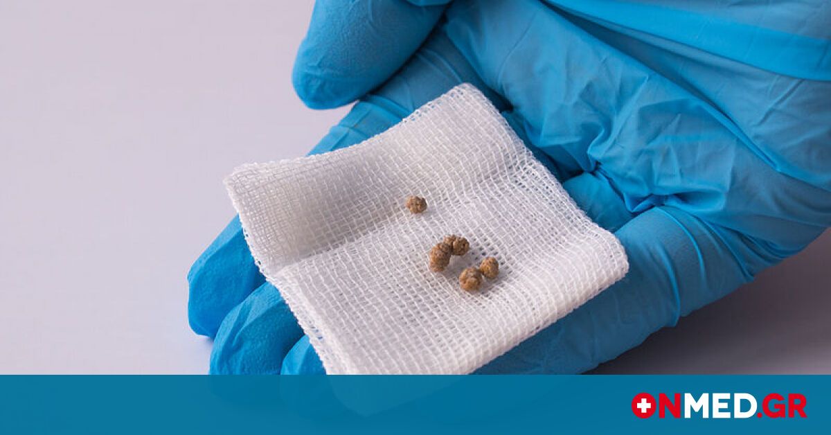 Πέτρες στη χολή: Οι βασικοί κανόνες πρόληψης (εικόνες)