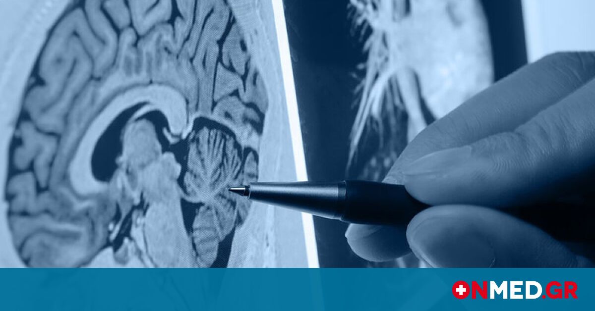Νέα «υπερηχητική» μέθοδος θεραπείας του καρκίνου του εγκεφάλου