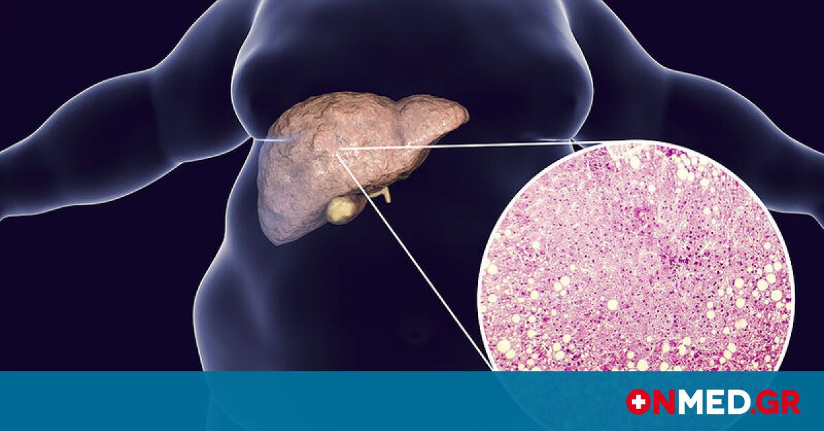 Λίπος στο συκώτι: Πώς θα αντιστρέψετε την κατάσταση (video)