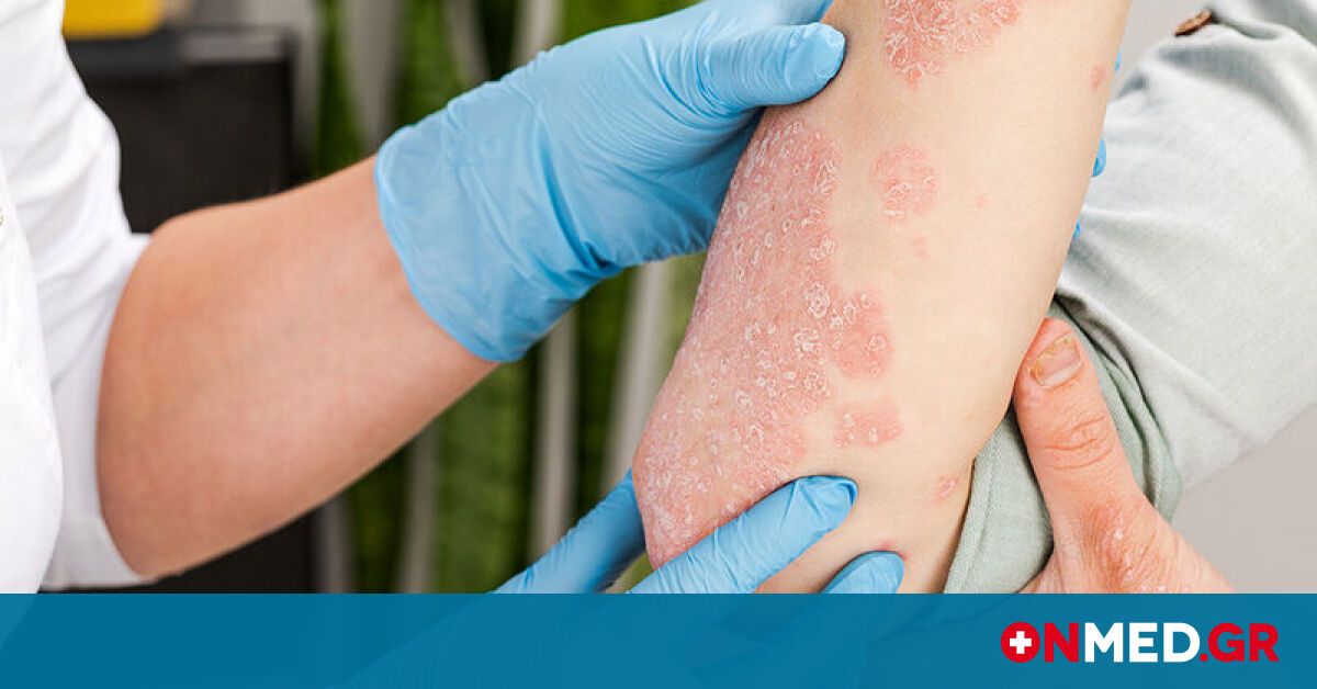 Δερματοπάθειες: Με ποιες άλλες παθήσεις συνδέονται (εικόνες)
