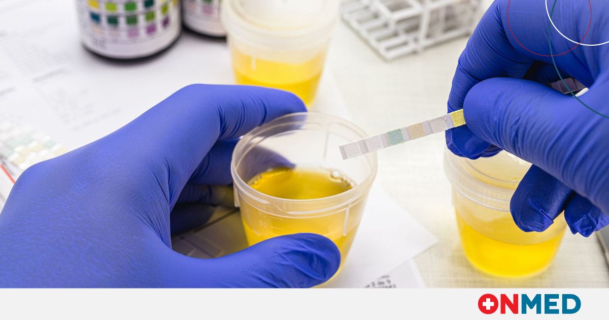 Το τεστ ούρων που εντοπίζει με ακρίβεια 99% δύο τύπους καρκίνου