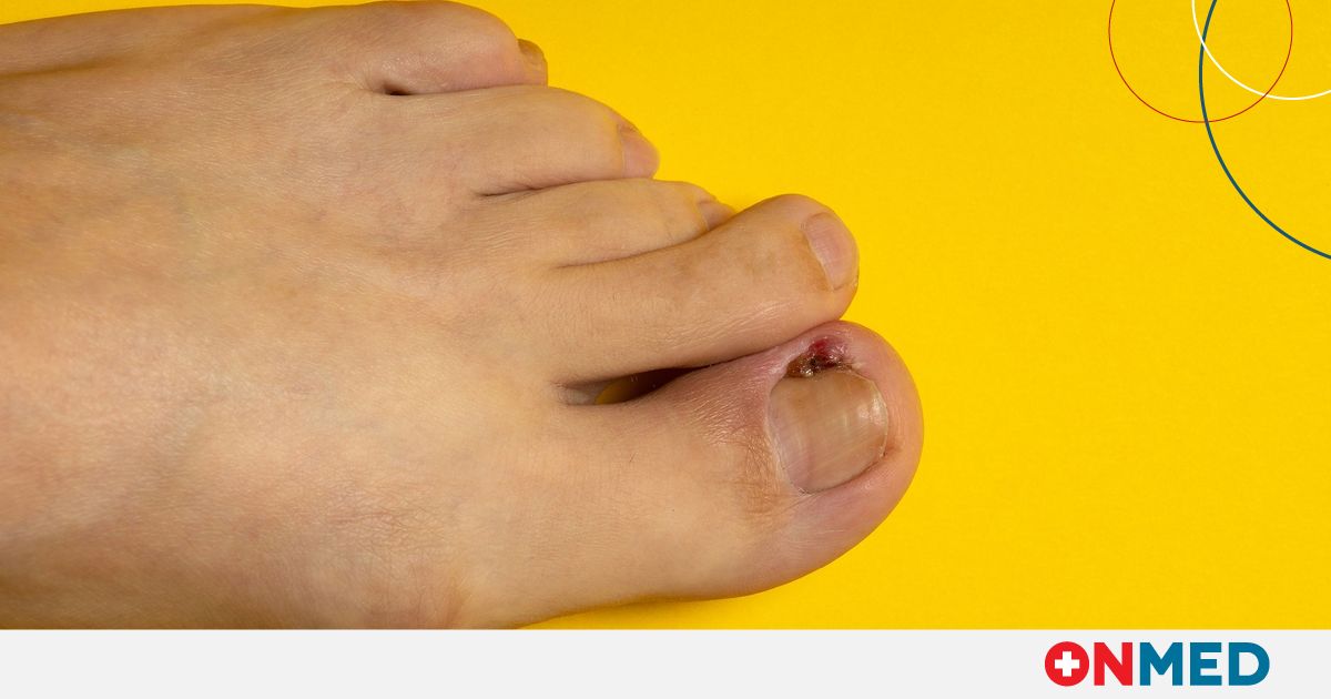 Νύχια που μπαίνουν στο δέρμα ή είσφρηση όνυχος: Πού οφείλεται το ...